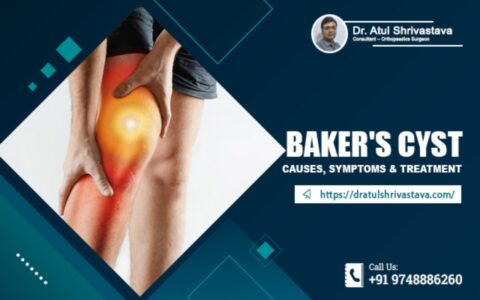 Baker’s Cyst: Causes, Symptoms, and Treatment | Dr. Atul Shrivastava